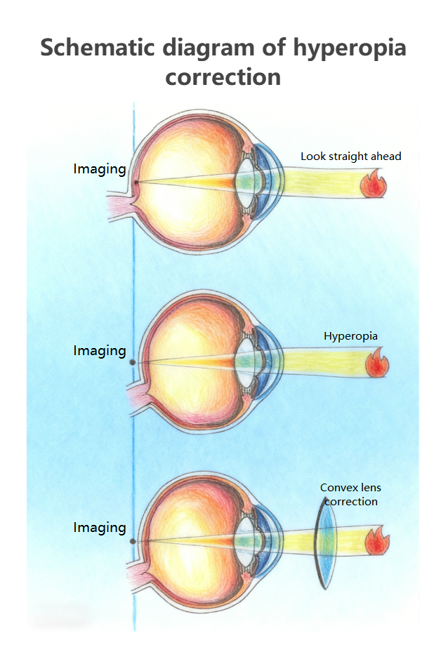 Hyperopia Correction Diagram | EdrawMax Templates